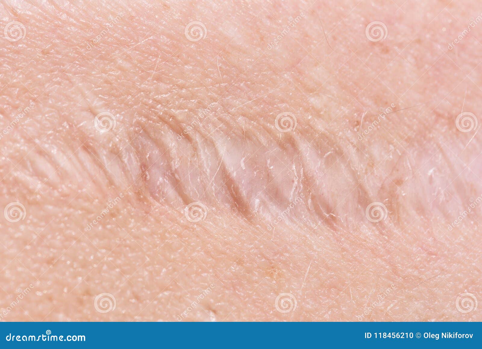 Narbe auf der Haut stockfoto. Bild von haut, narbe, verletzung - 118456210
