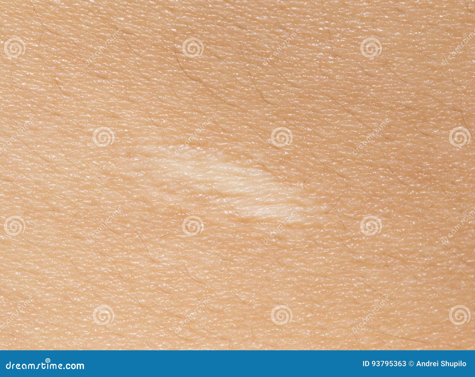 Narbe auf der Haut Makro stockbild. Bild von markierung - 93795363