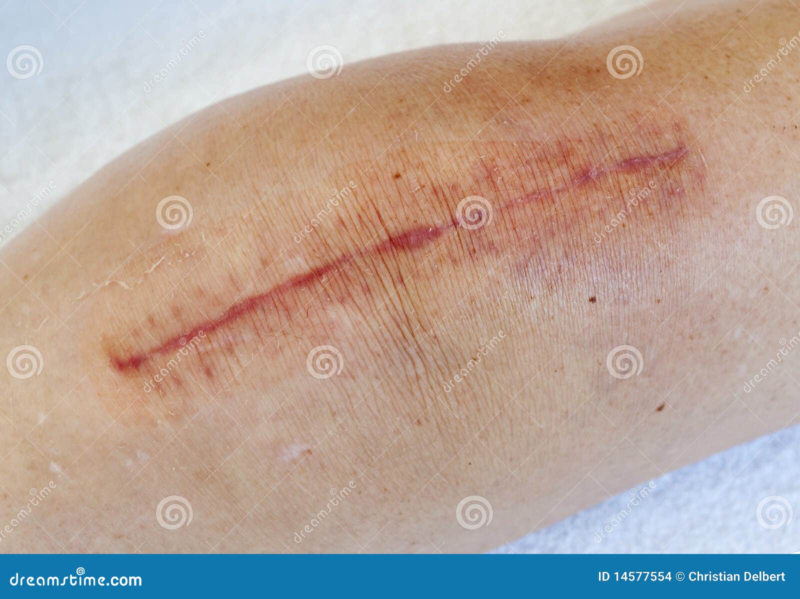 Narbe Von Der Kniechirurgie Stockfoto - Bild von entflammt, geduldig ...