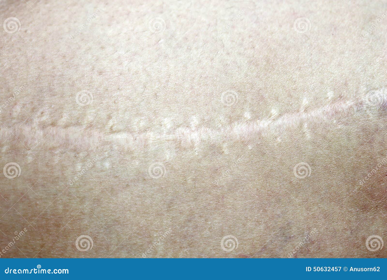Narbe von der Operation stockbild. Bild von lederhaut - 50632457