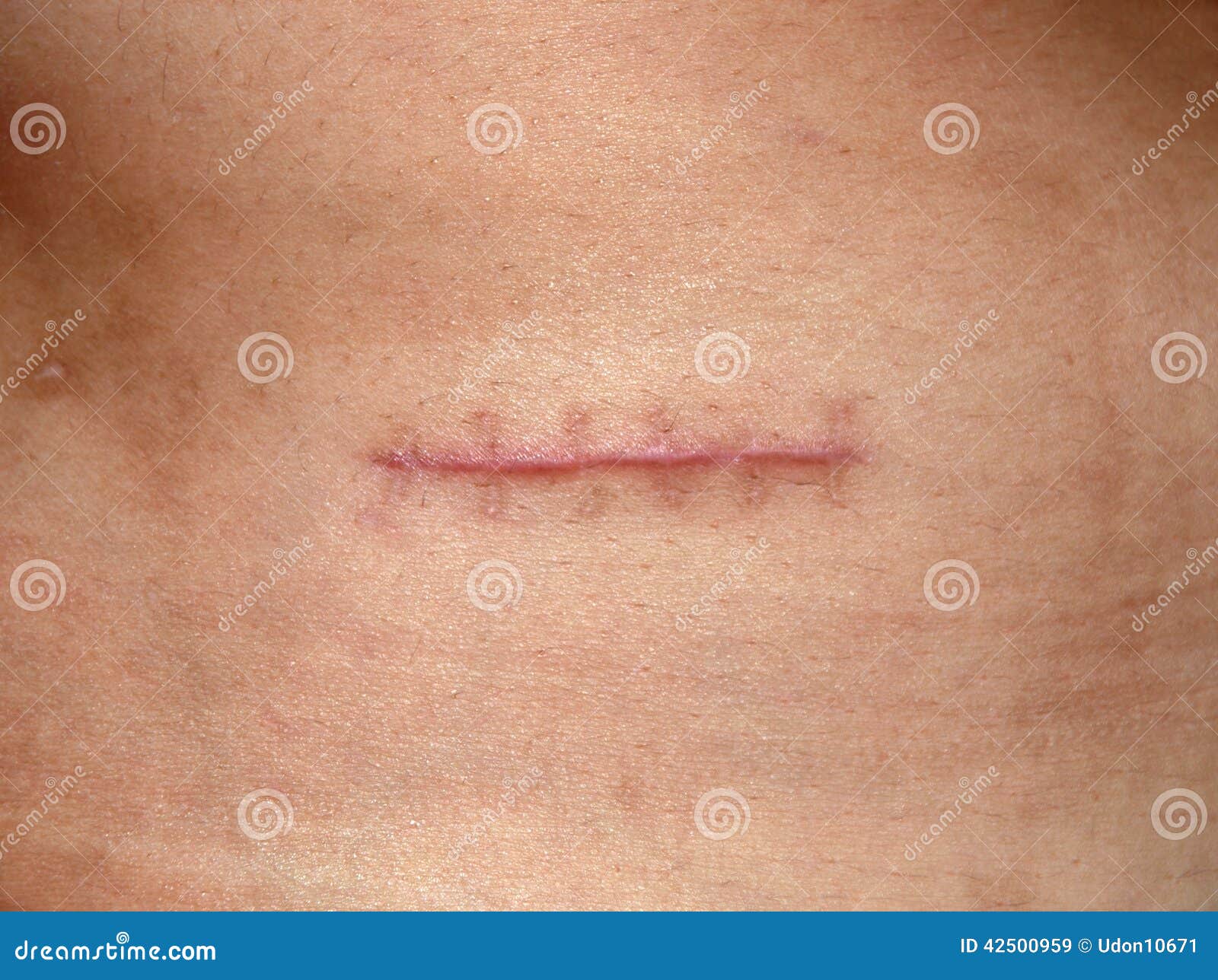 Narben Von Der Blinddarmoperation Stockbild - Bild von leute, krebs ...