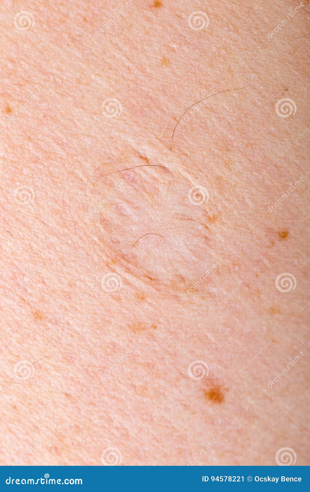 Narbengewebe Auf Menschlicher Haut Stockbild - Bild von gealtert ...