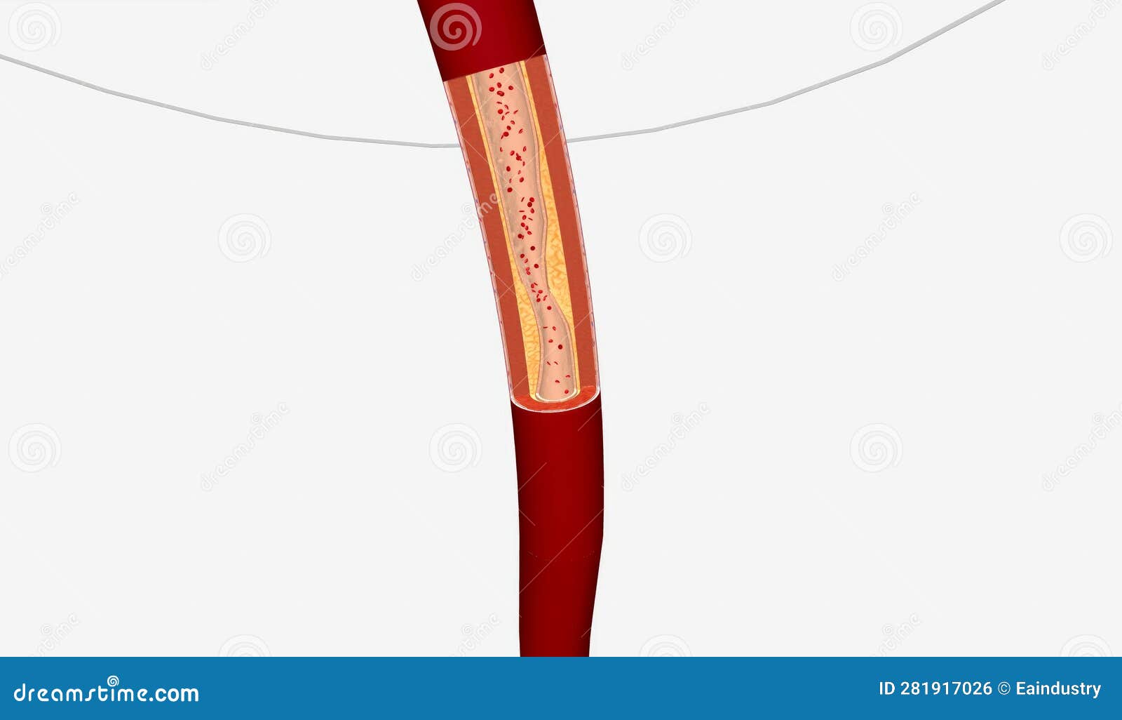 Atherosclerosis Of The Lower Extremities. Leg Artery Disease ...