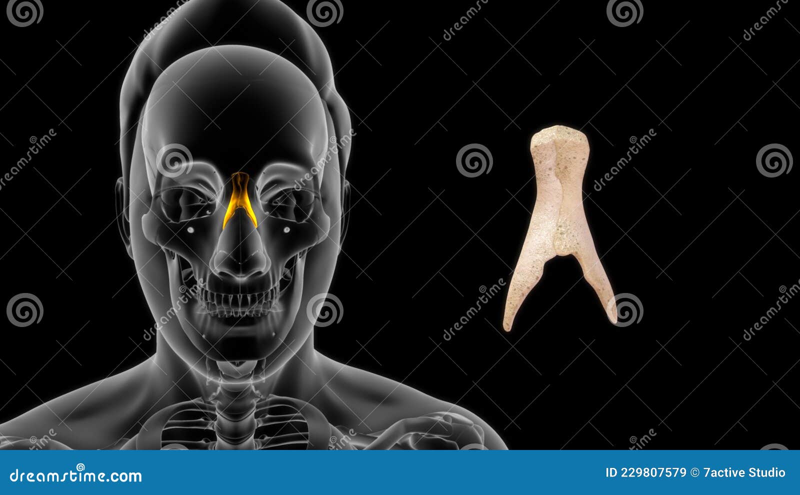 The Nasal Cartilages Are The Septal, Lateral, Major Alar, And Minor ...