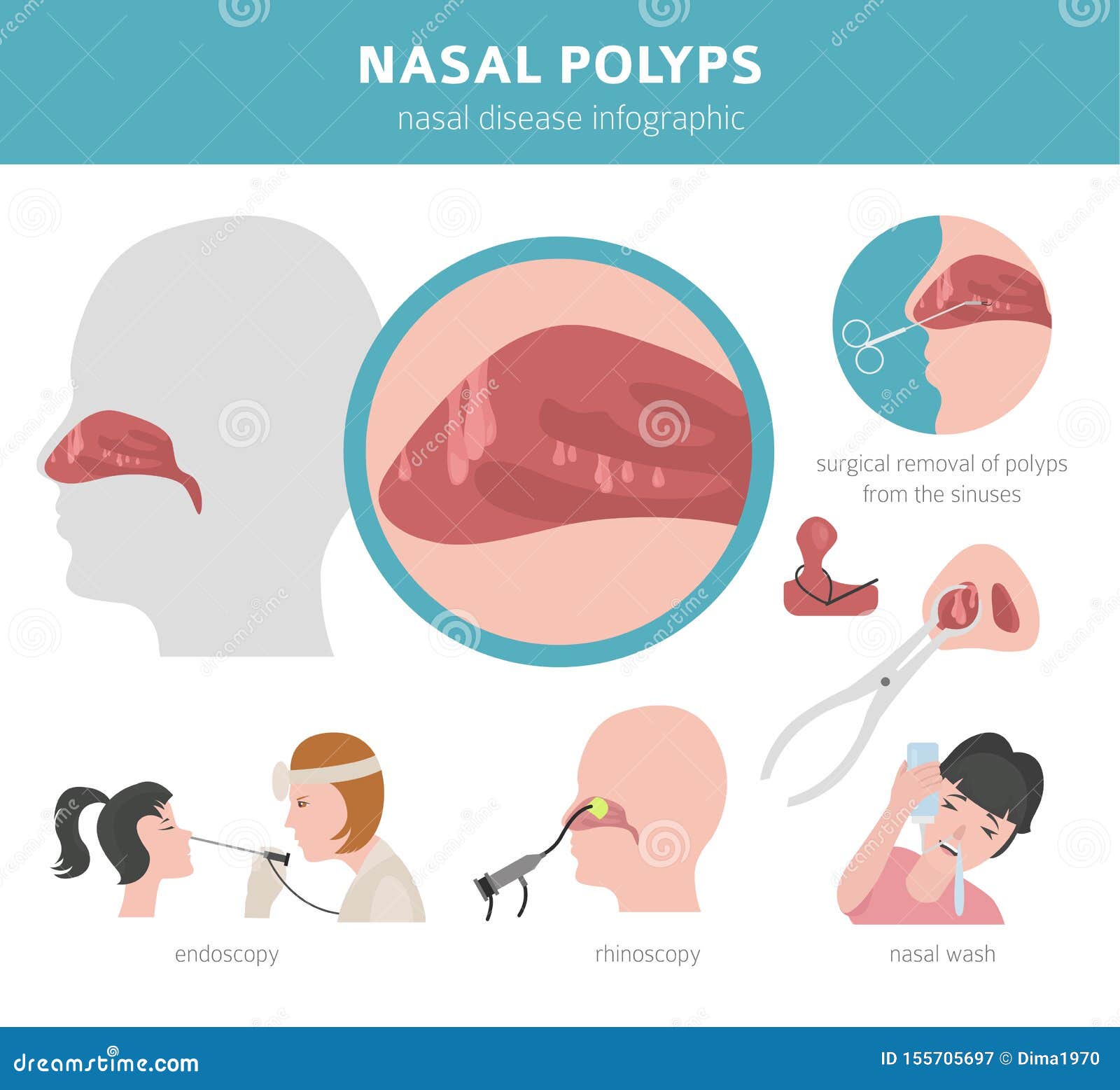 Nasal Diseases Nasal Polyps Causes Diagnosis And Treatment Medical