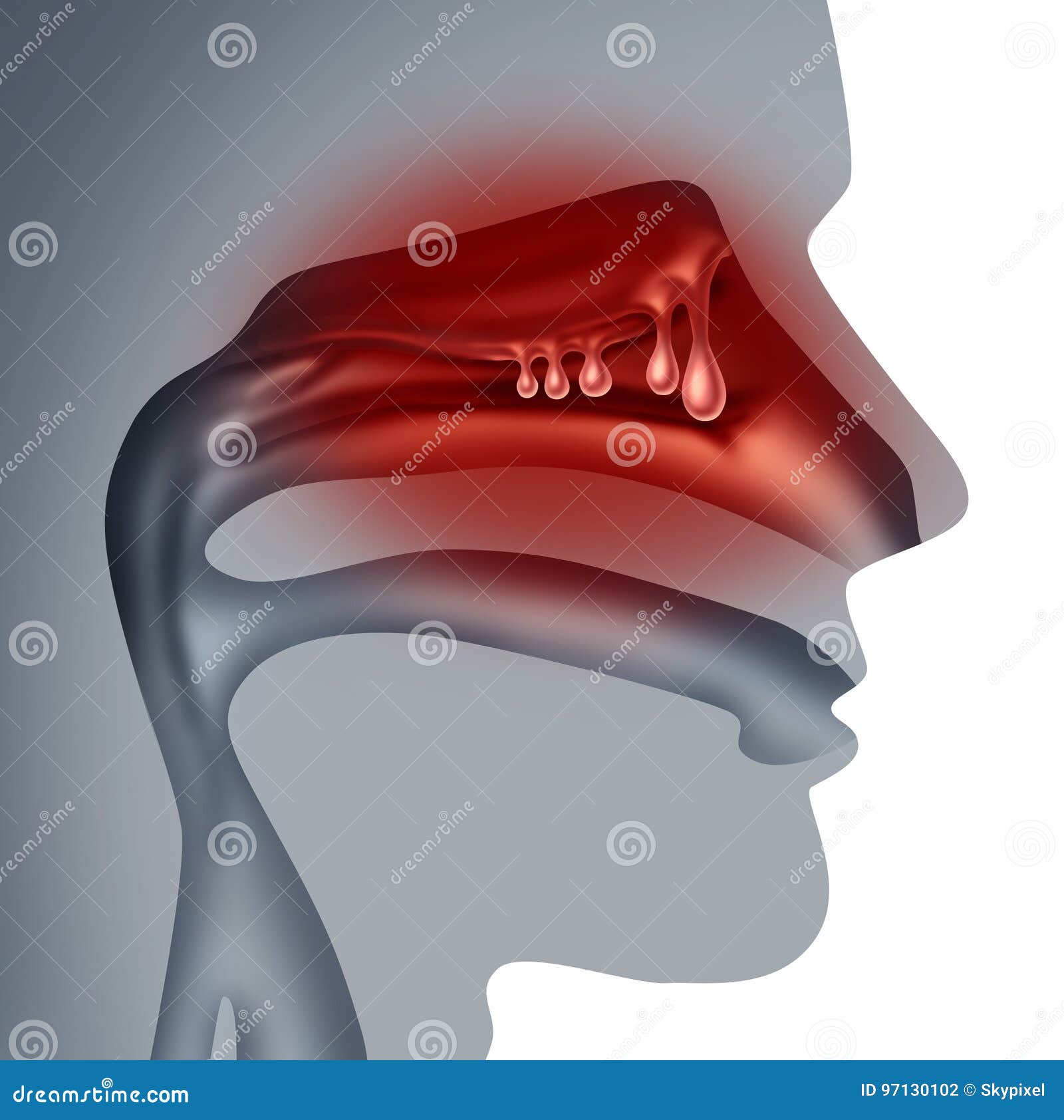 Nasale Polypen stock abbildung. Illustration von konzept - 97130102