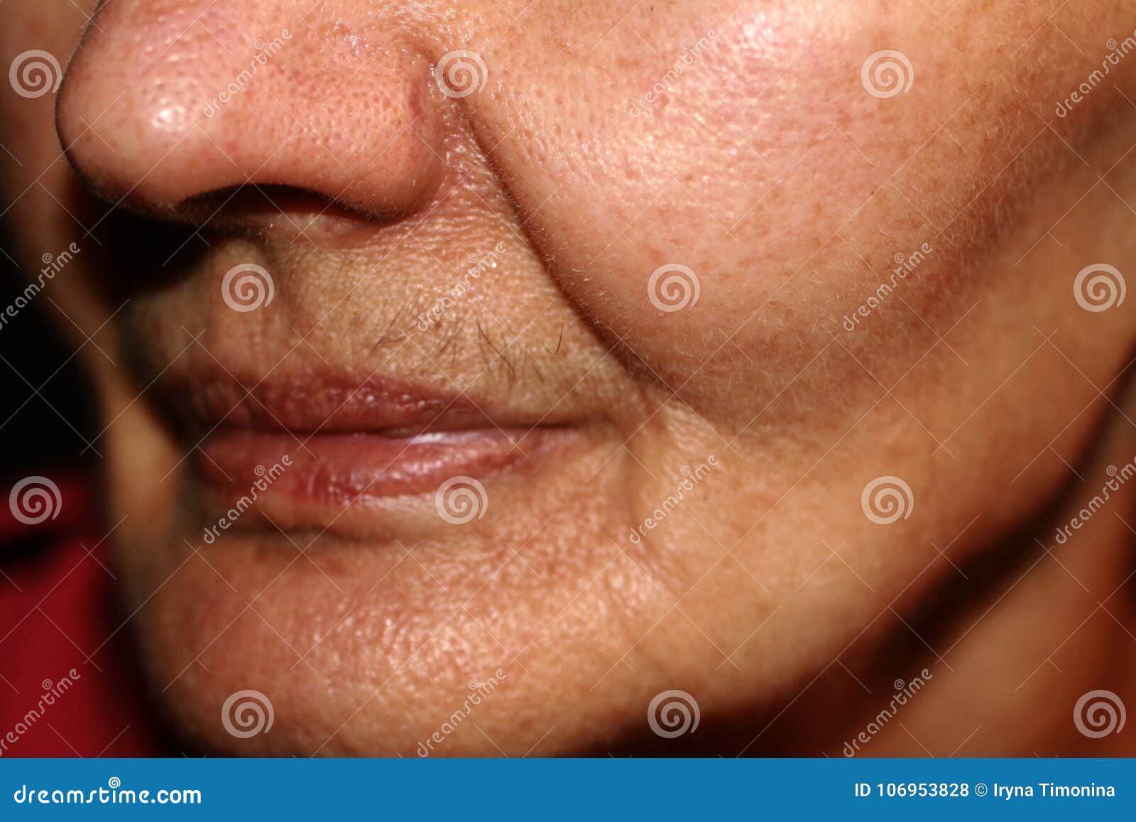 Nasolabial Wrinkled Fold on the Skin of the Face. Stock Photo - Image ...