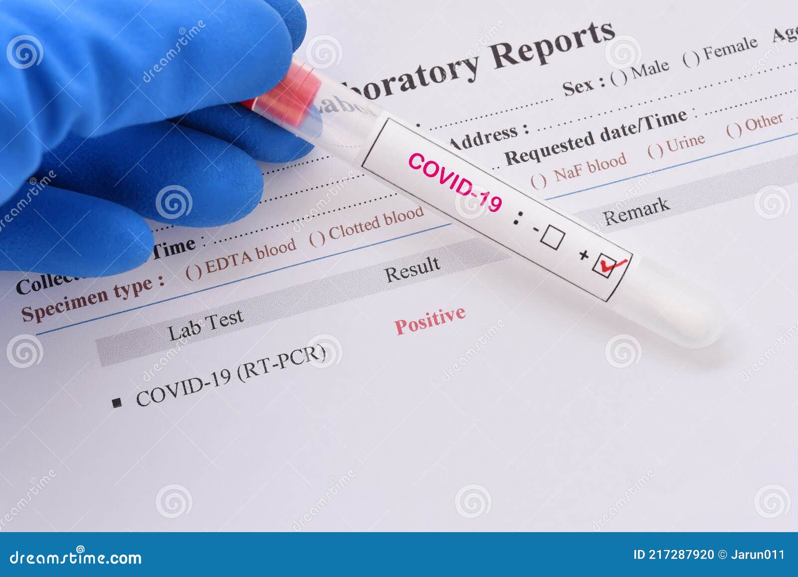 Nasopharyngeal Swab Positive with COVID-19 Stock Photo - Image of ...