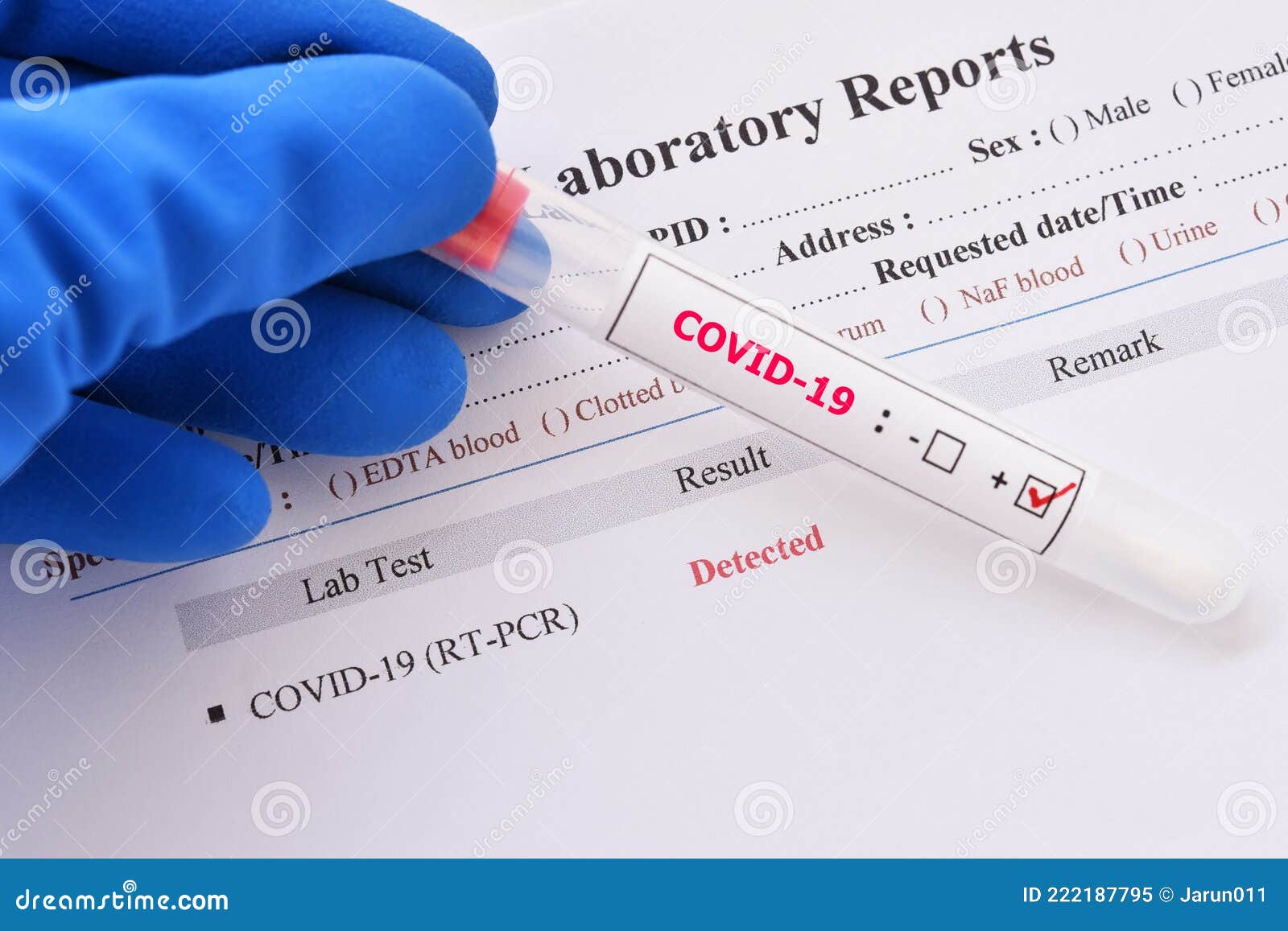 Nasopharyngeal Swab Positive with COVID-19 Stock Image - Image of ...