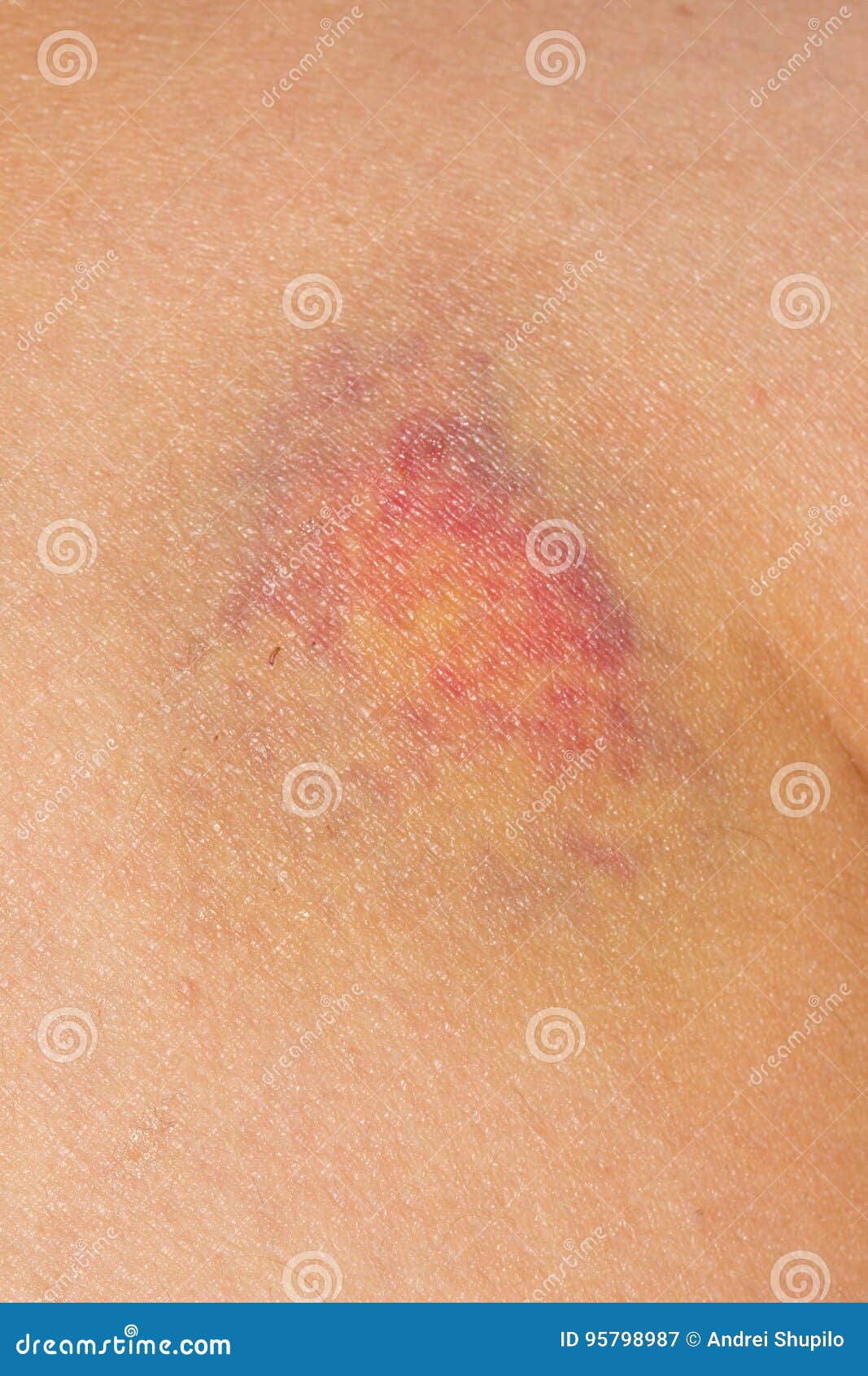 Nasty Looking Bruise on Hip, Macro Shot Stock Image - Image of surface ...