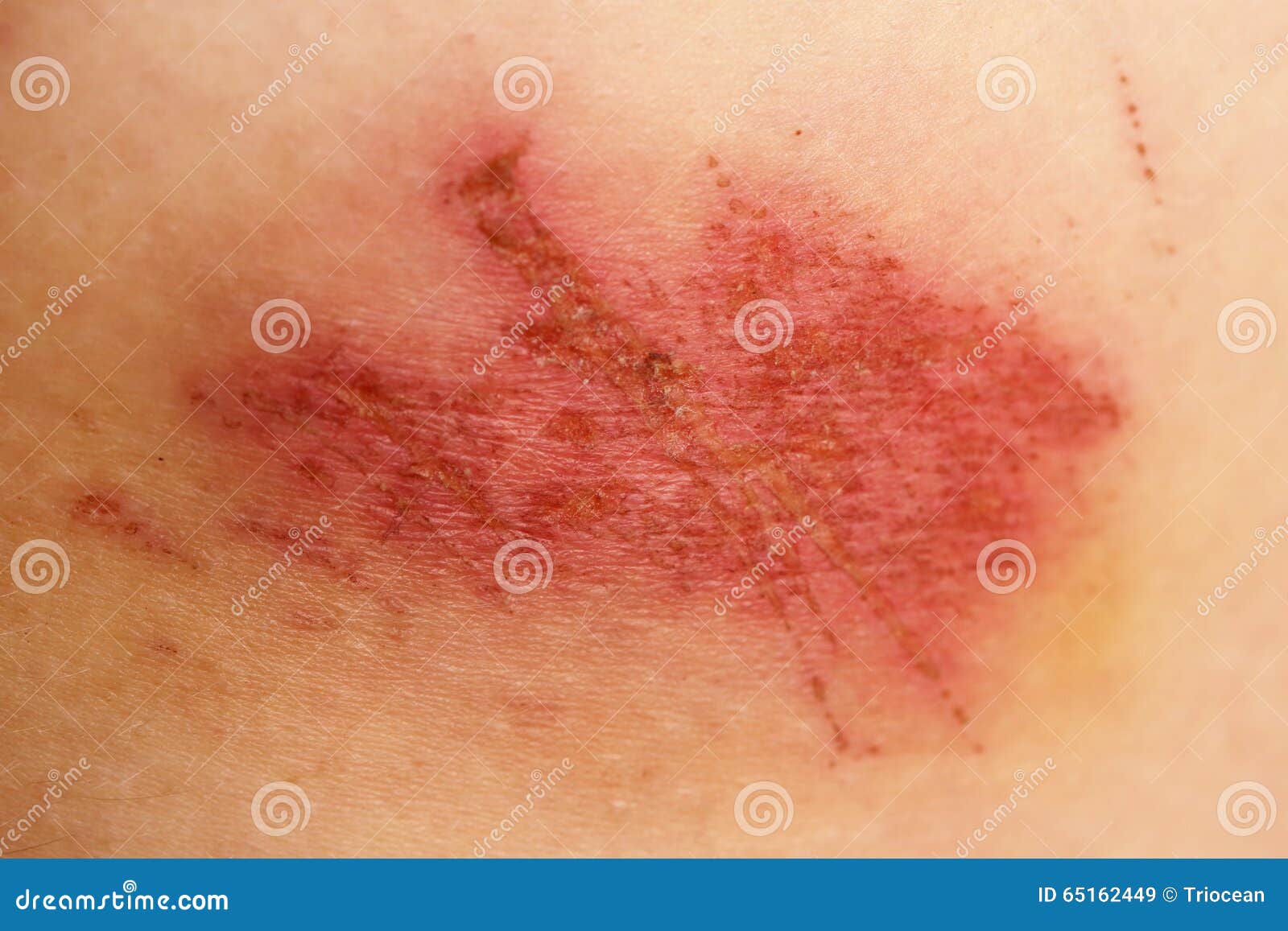 Wound Fresh Wounds Royalty-Free Stock Photo | CartoonDealer.com #77767293