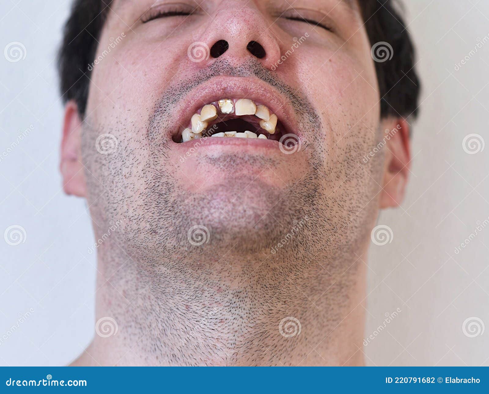 Portrait of a Man with Broken Teeth Stock Photo - Image of hygiene ...