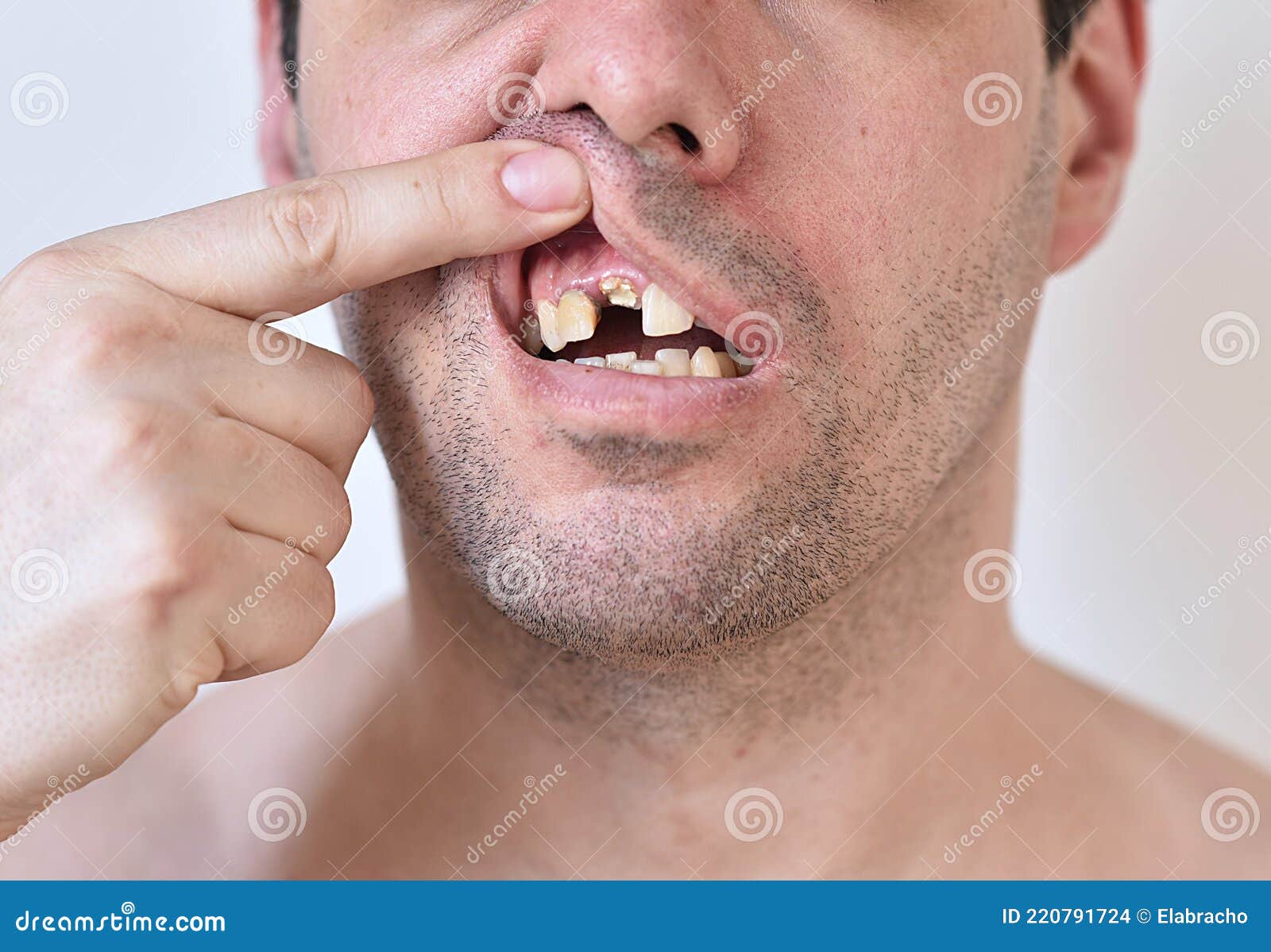Portrait of a Man with Broken Teeth Stock Photo - Image of dentist ...