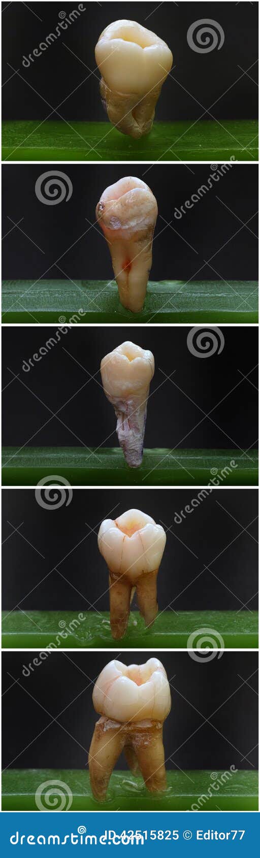 Natural human teeth stock image. Image of corona, molar - 42515825