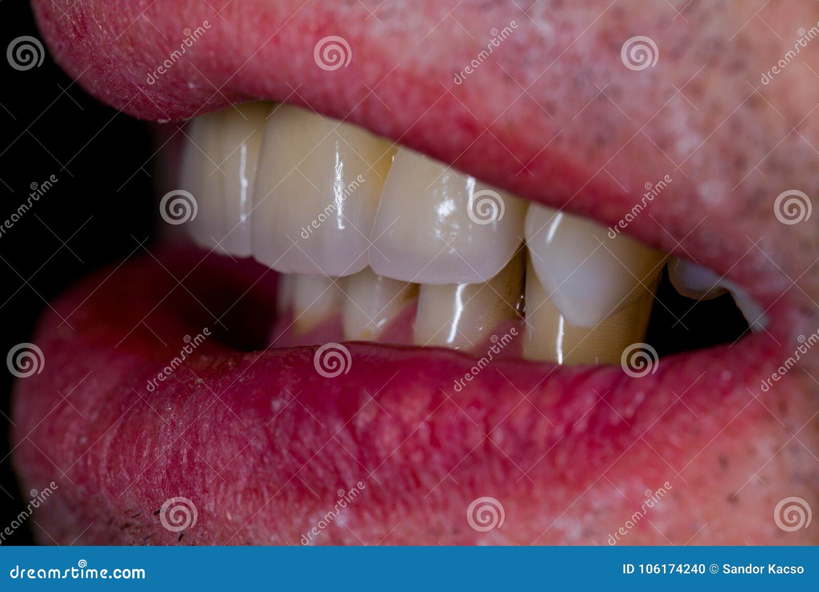 Natural Looking Artificial Ceramic Teeth Stock Photo - Image of metal ...