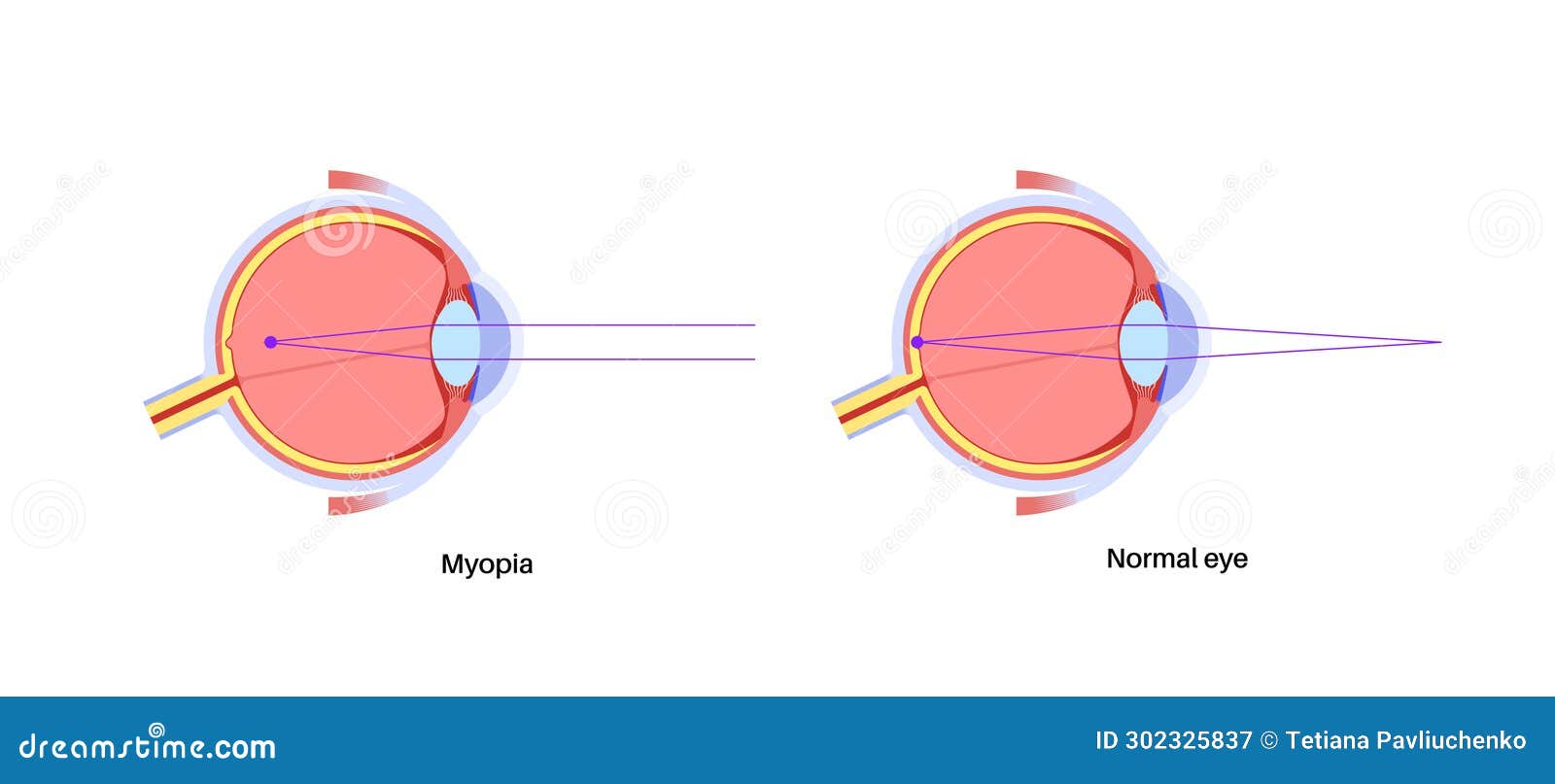 Normal Eye and Nearsightedness Stock Vector - Illustration of cornea ...