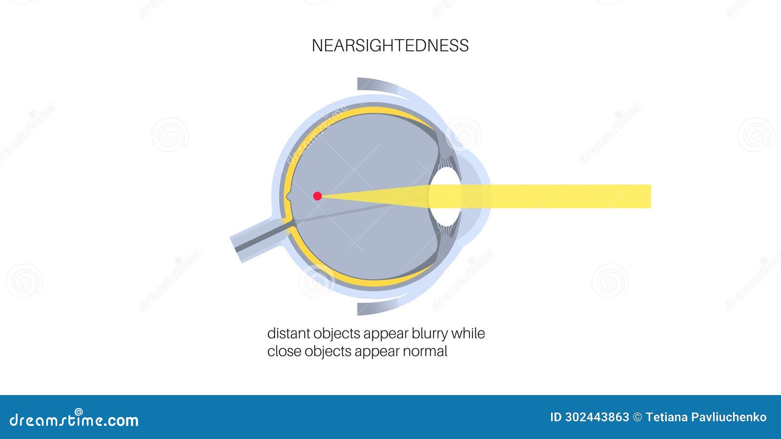 Nearsightedness Eye Disease Stock Vector - Illustration of surface ...