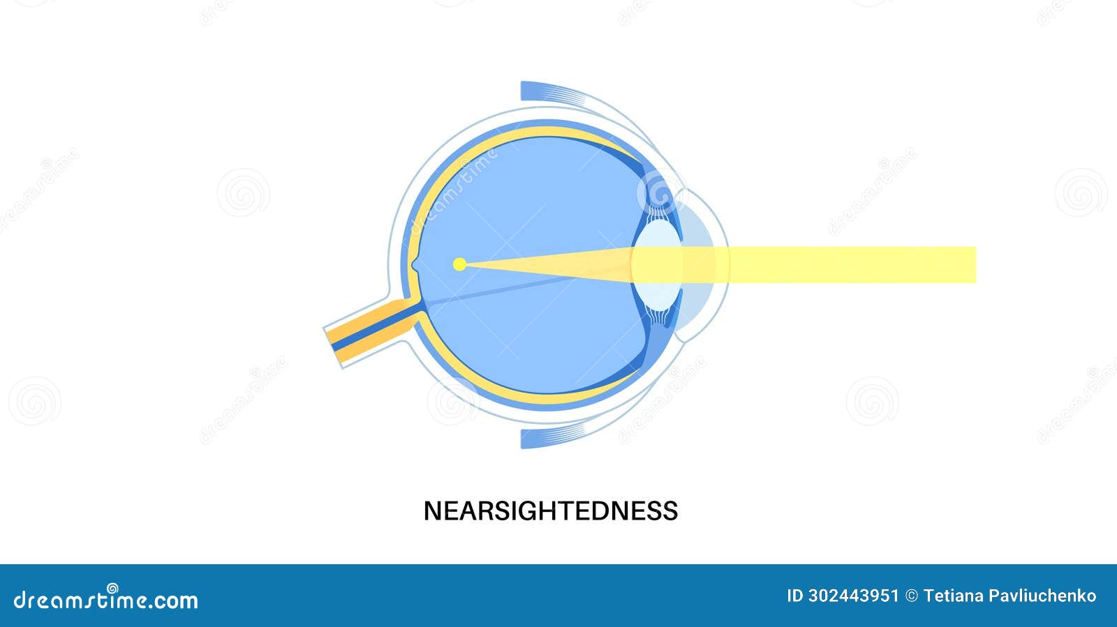 Nearsightedness Eye Disease Stock Vector - Illustration of ball, cornea ...