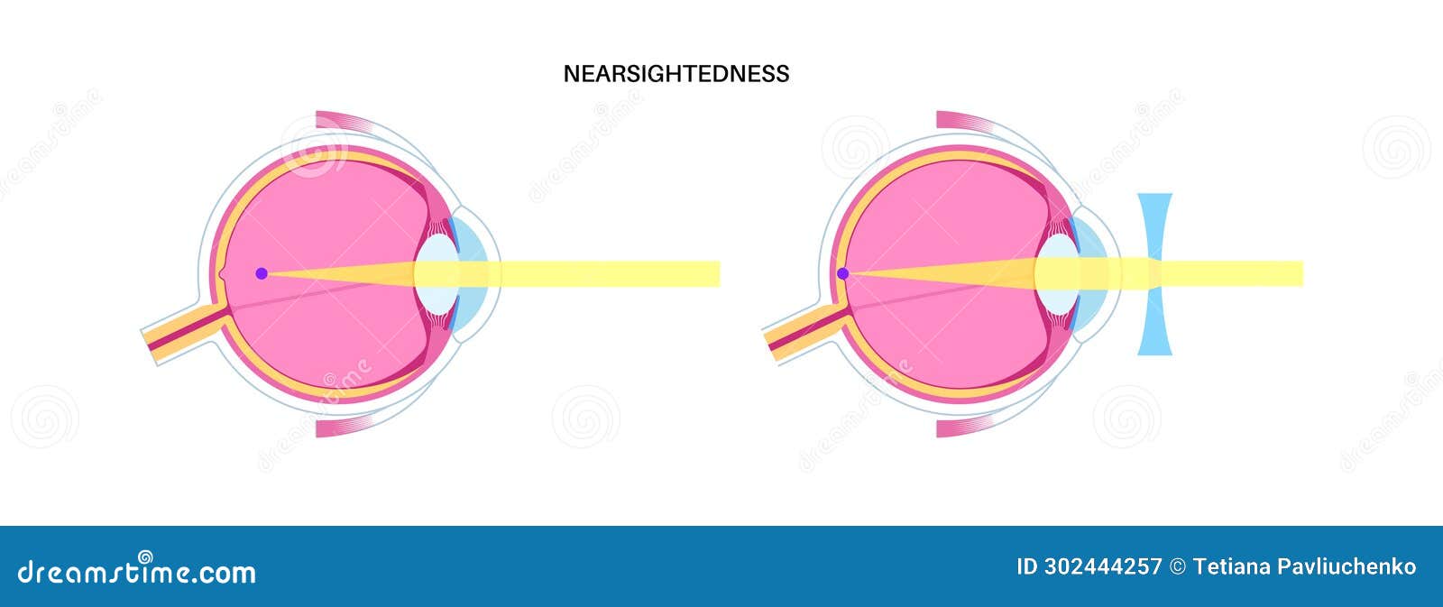 Normal Eye and Nearsightedness Stock Vector - Illustration of cornea ...