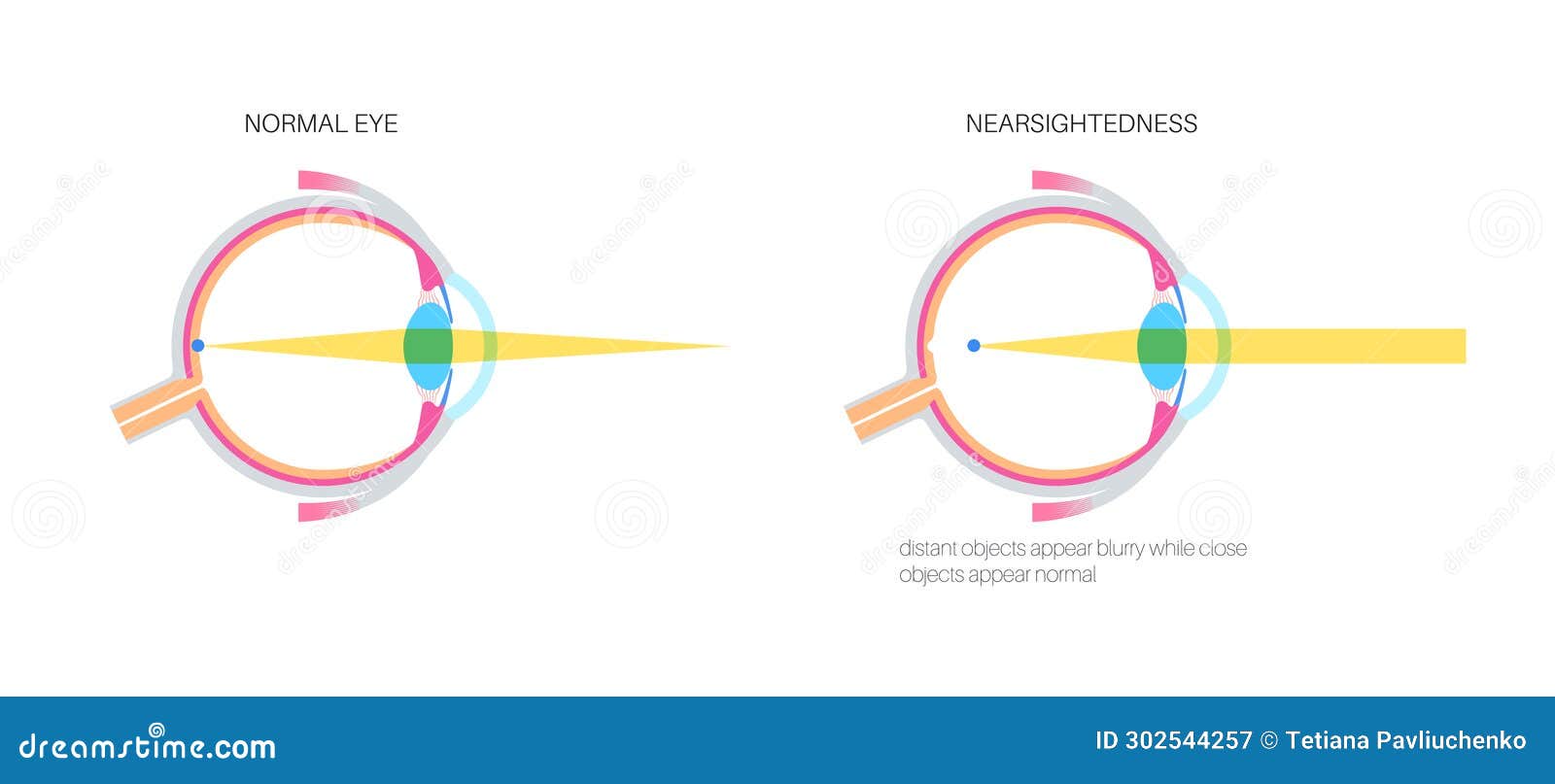 Normal Eye and Nearsightedness Stock Vector - Illustration of human ...