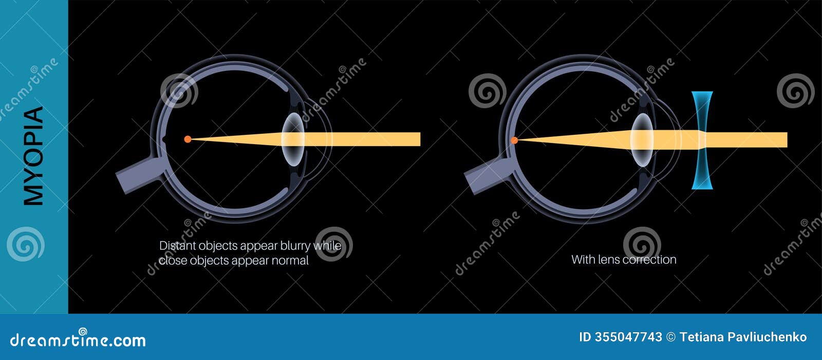 Myopia lens correction stock illustration. Illustration of sight ...