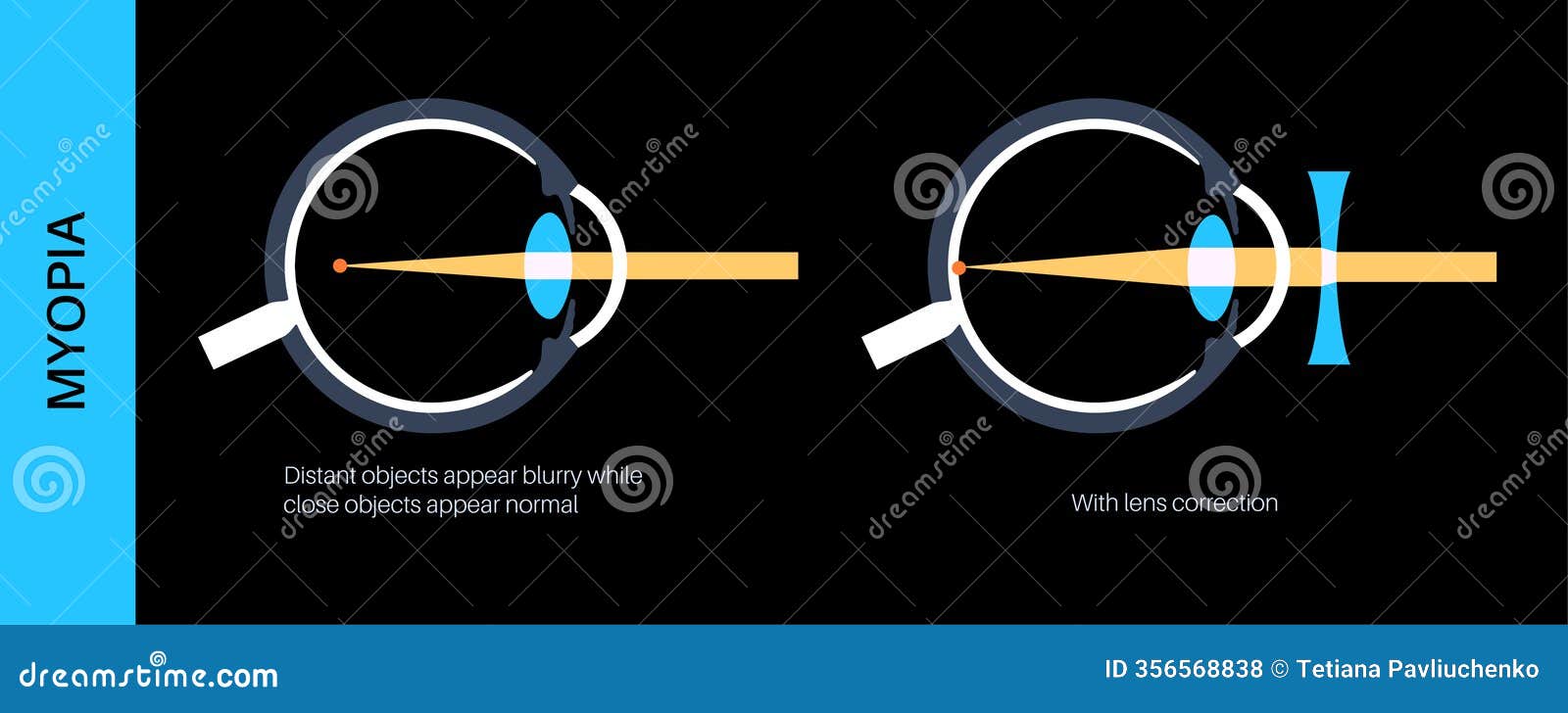 Myopia lens correction stock illustration. Illustration of pupil ...