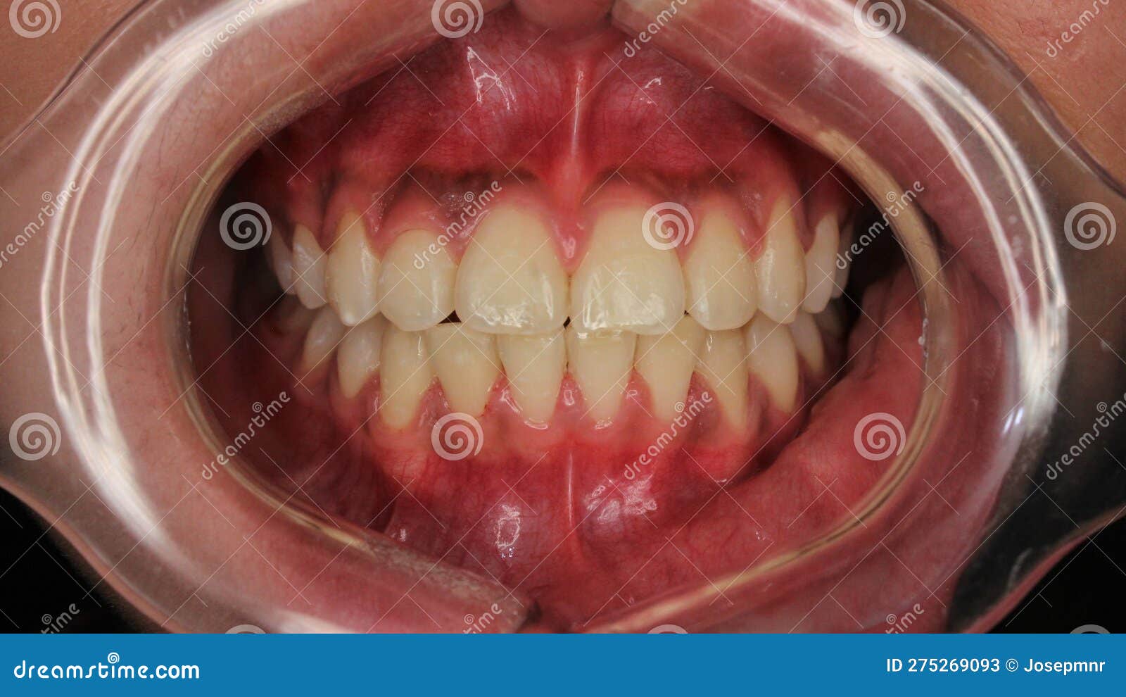 Neat and Healthy Appearance of Human Teeth, with the Help of a ...