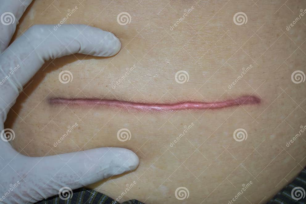 Neat Tidy And Clean Hypertrophic Scar Straight Surgical Incision