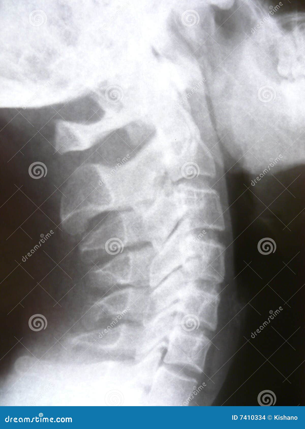 Neck bone stock photo. Image of spinal, medical, radiology - 7410334
