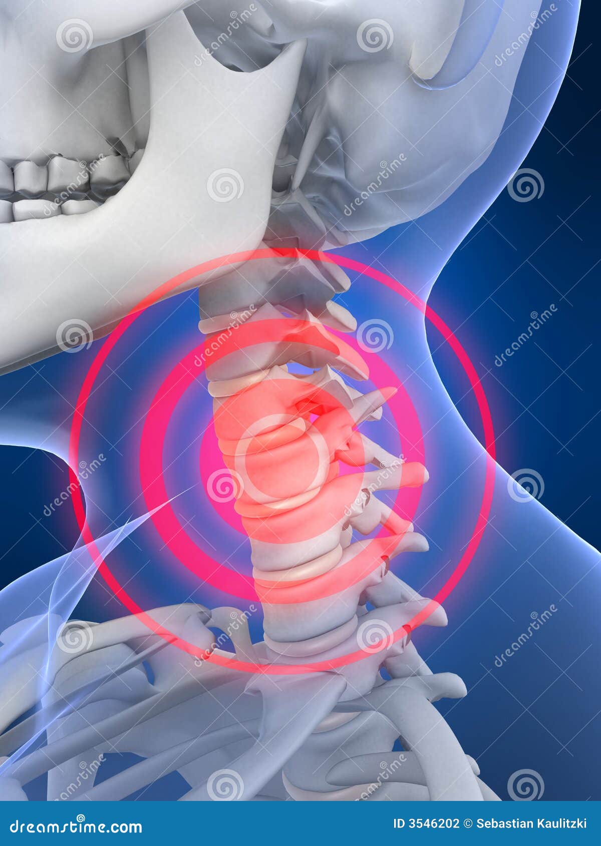 Neck inflammation stock illustration. Illustration of biology - 3546202