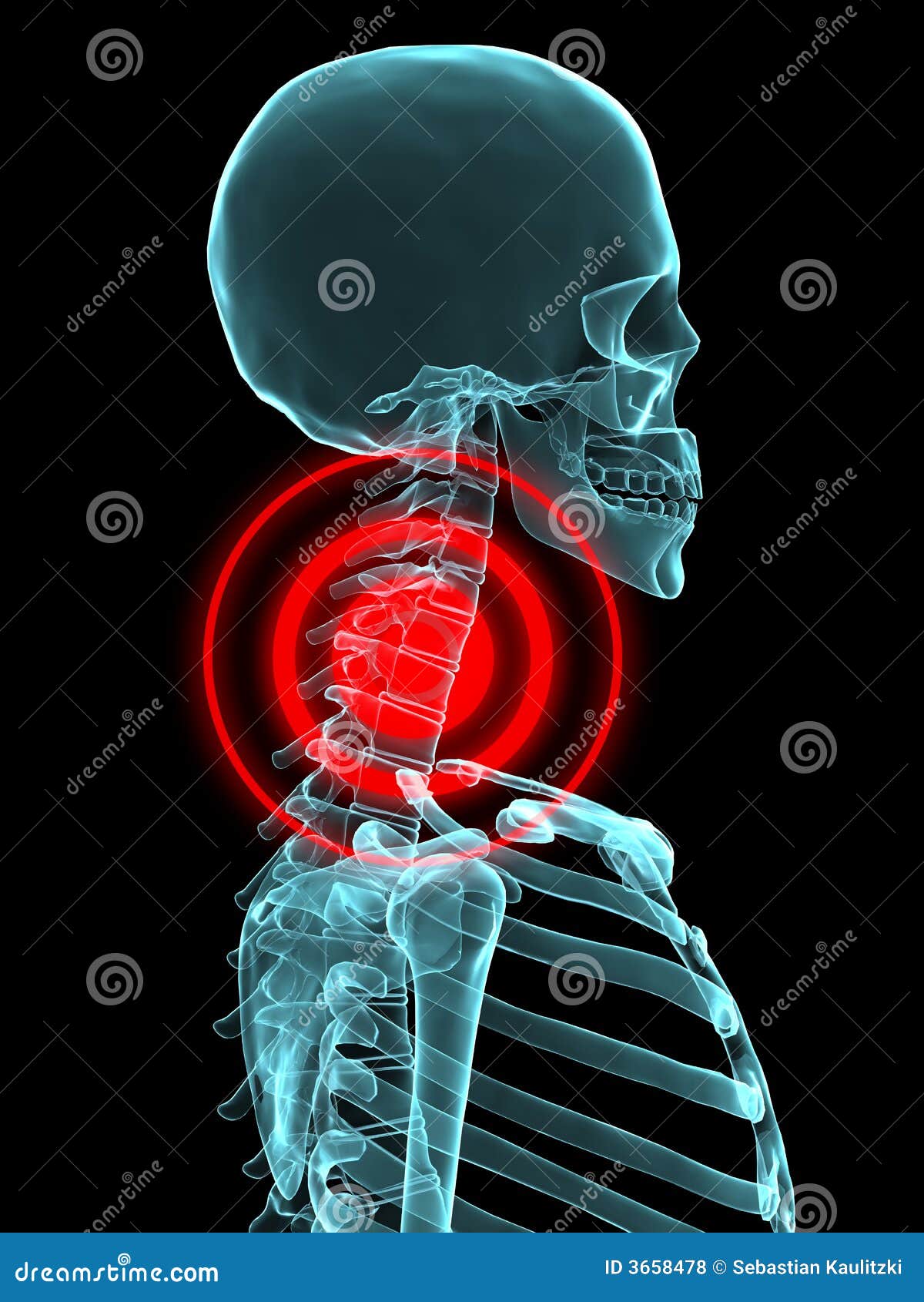 Neck inflammation stock illustration. Illustration of joint - 3658478