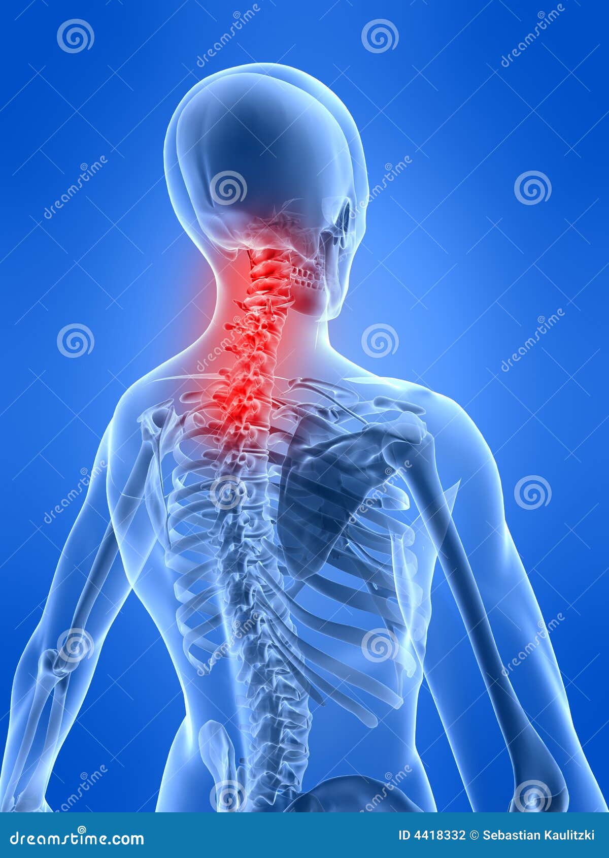 Neck inflammation stock illustration. Illustration of rheumatism - 4418332