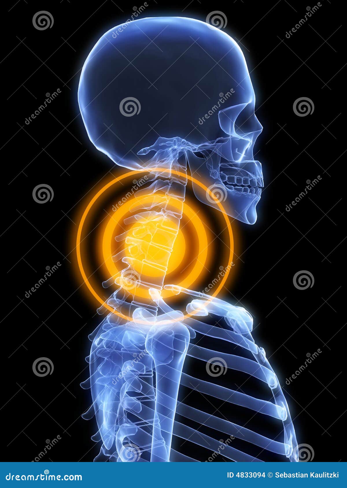 Neck inflammation stock illustration. Illustration of backache - 4833094