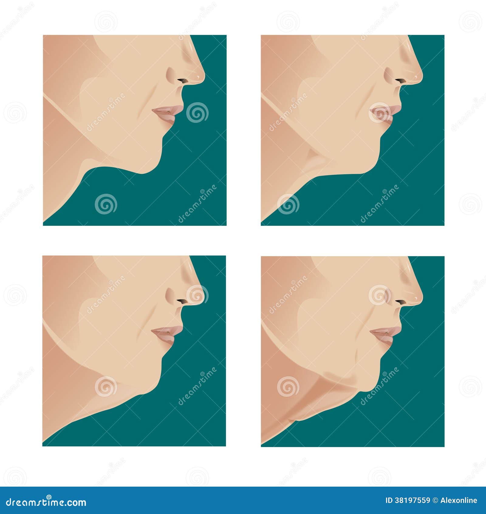 Neck lift stock vector. Illustration of lift, operation - 38197559