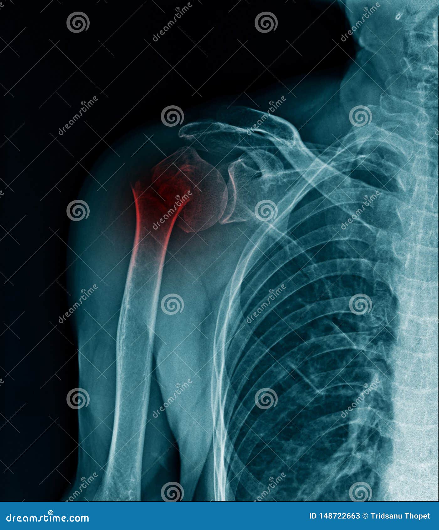 Neck og humerus fracture stock image. Image of room - 148722663