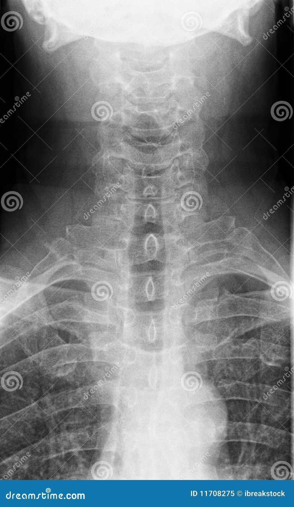 Neck x-ray stock image. Image of examination, cervical - 11708275