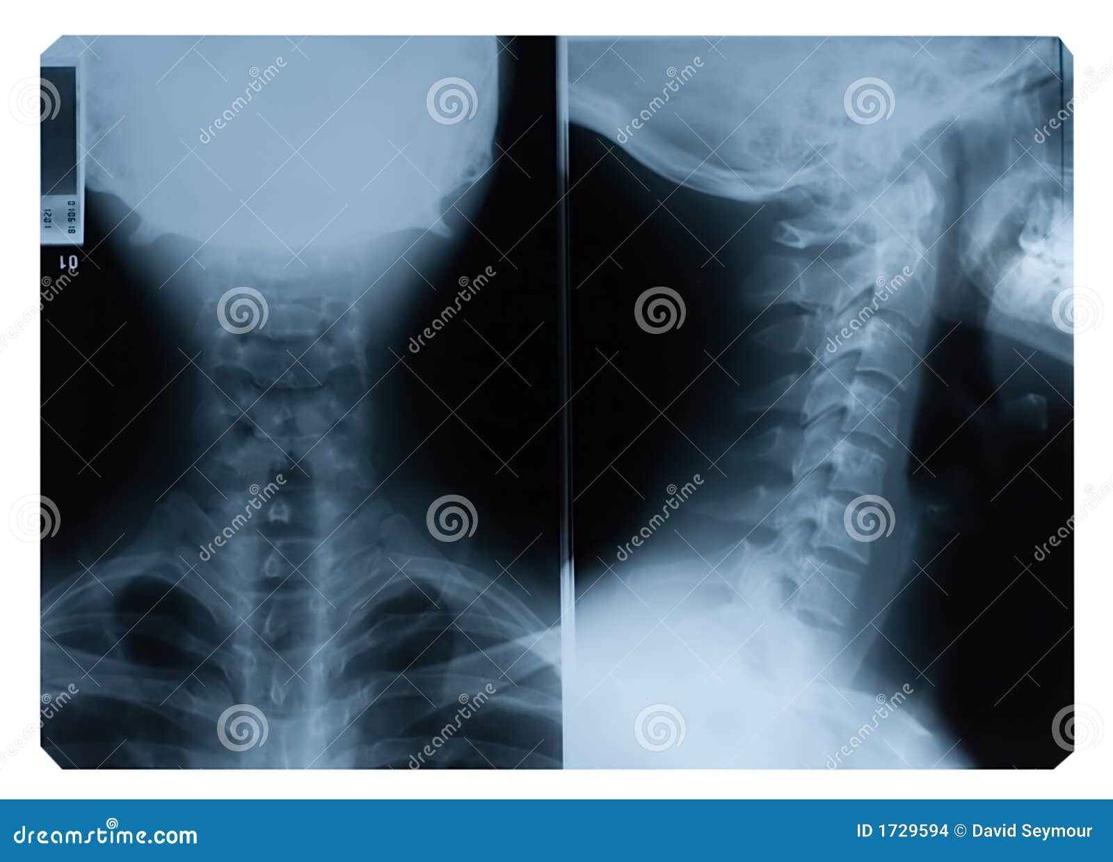 Neck X-Ray front and side stock photo. Image of ligaments - 1729594