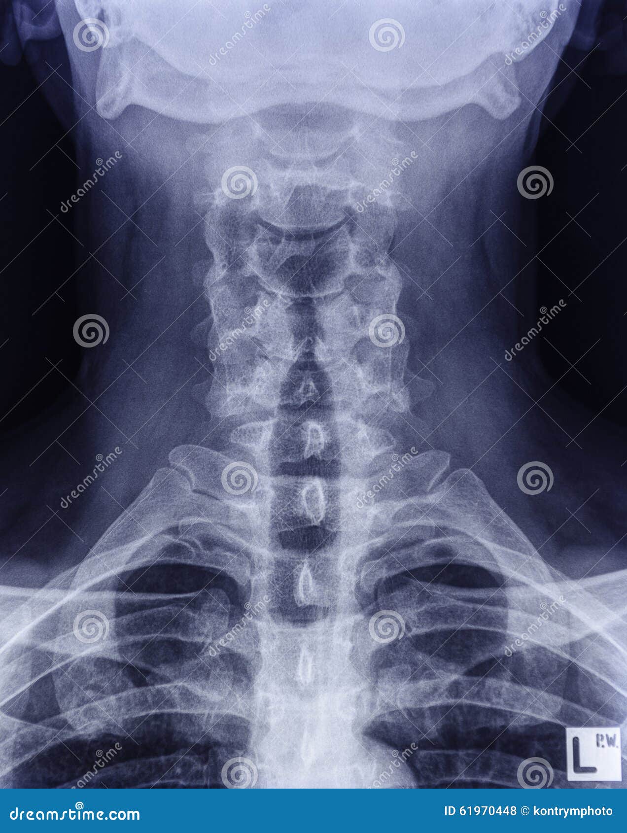 Neck x-ray stock photo. Image of spinal, scan, analyzing - 61970448