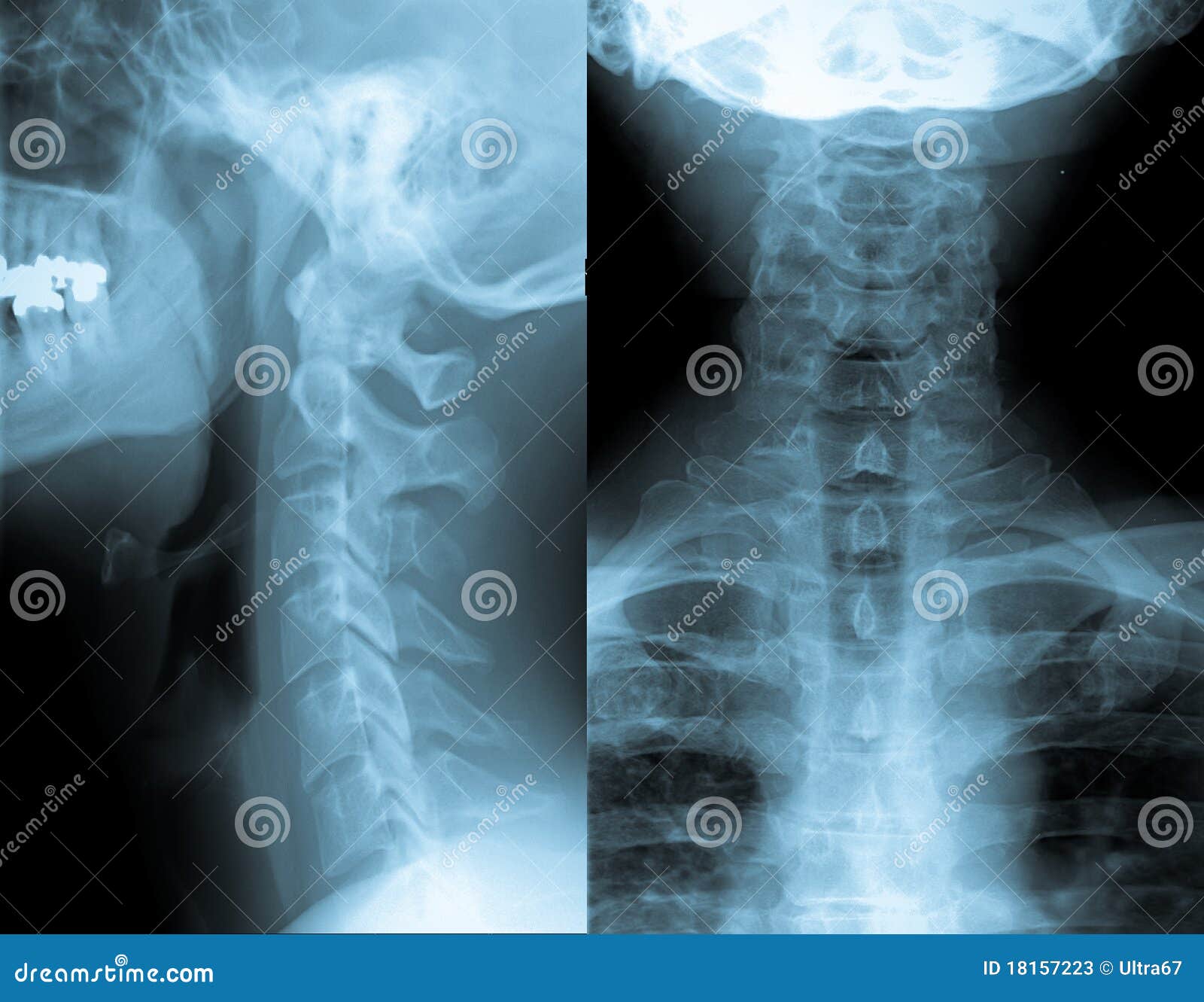 Neck X Ray stock image. Image of medicare, diagnostic - 18157223