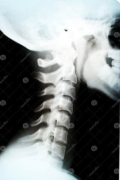 Neck xray picture stock image. Image of care, brain, film - 13880301