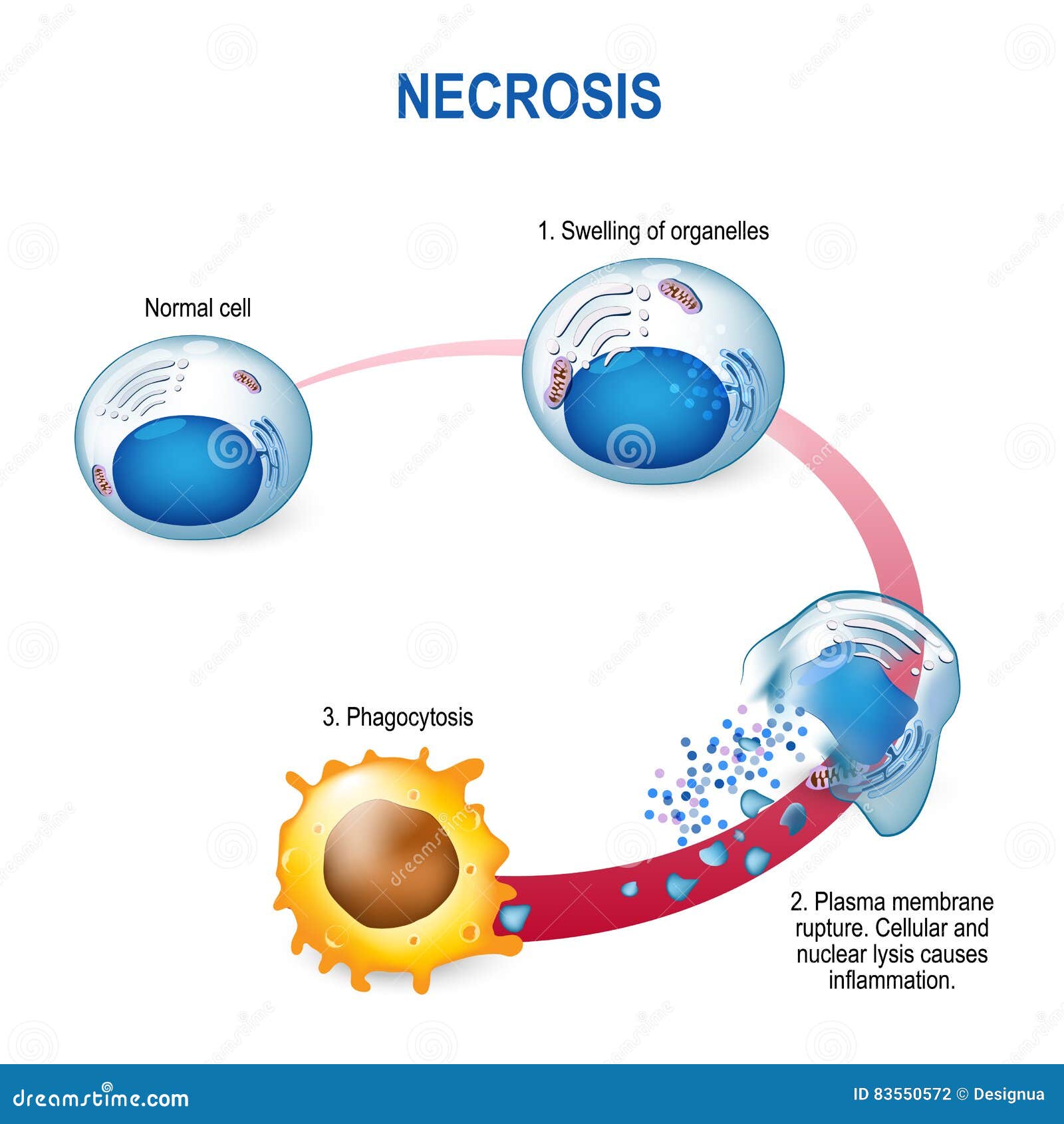 Necrose ilustração do vetor. Ilustração de morte, humano - 83550572