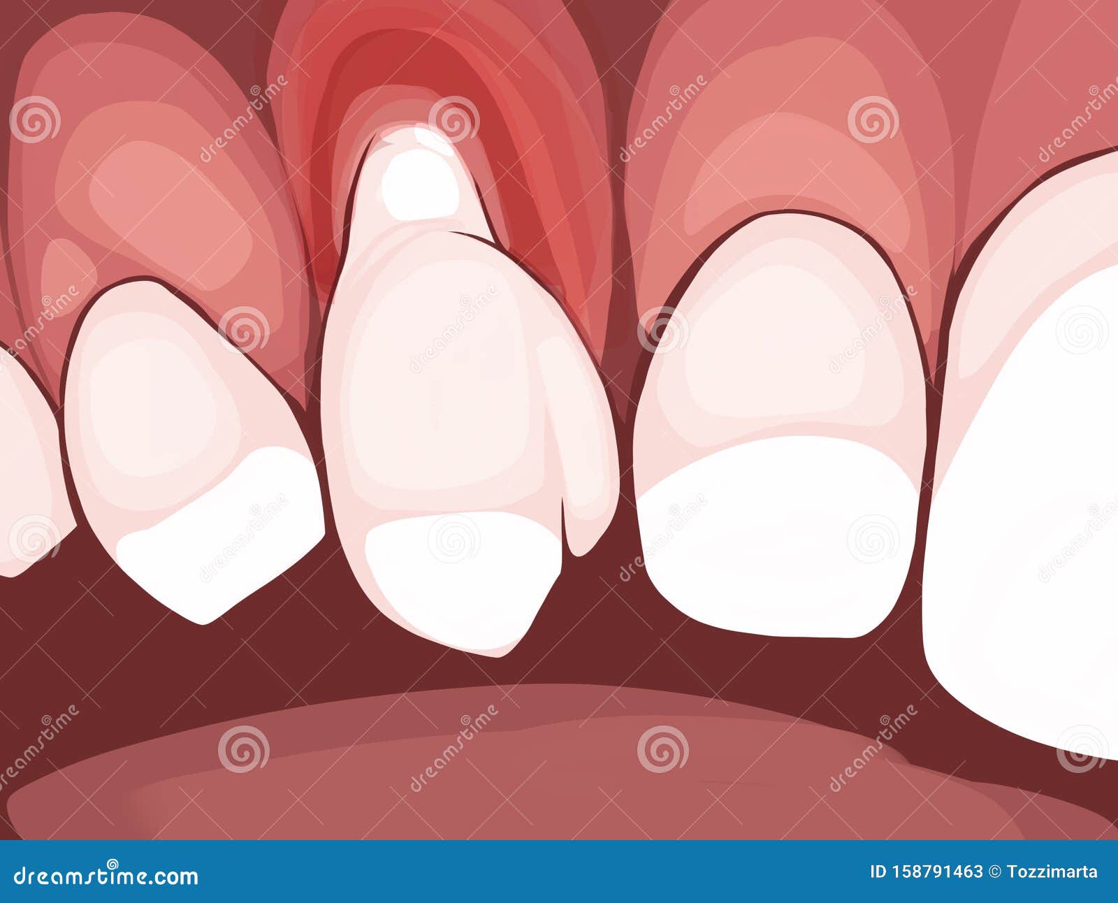 Gingivitis Or Periodontal Disease, Inflammation Of The Gum Tissue ...