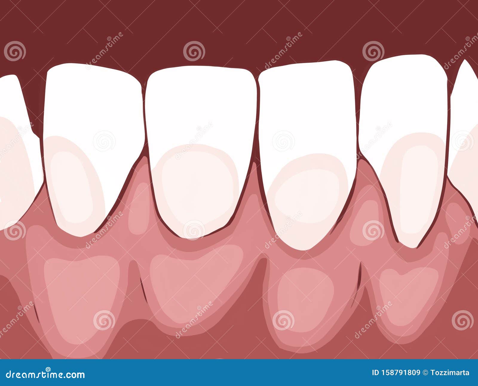 Necrotizing Ulcerative Periodontal Disease