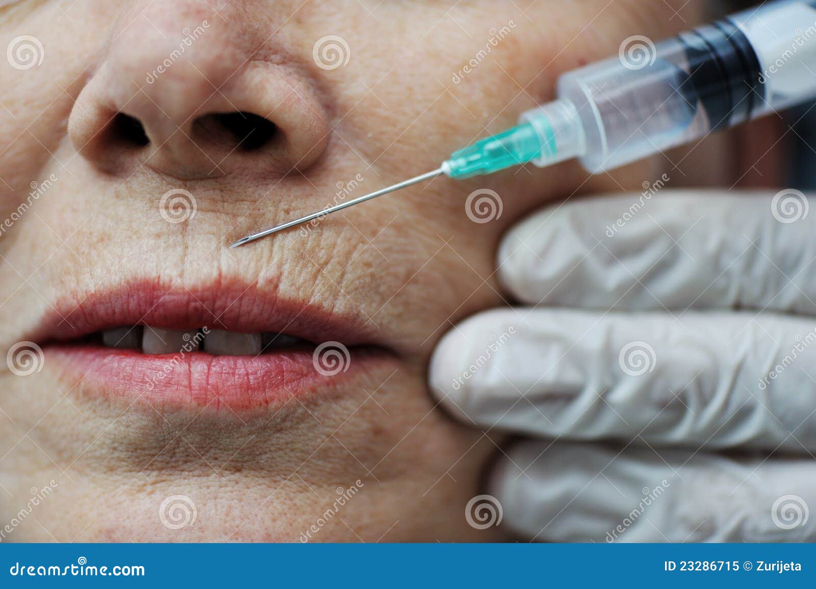 Needle Injection on Mature Face Stock Image - Image of hospital, female ...