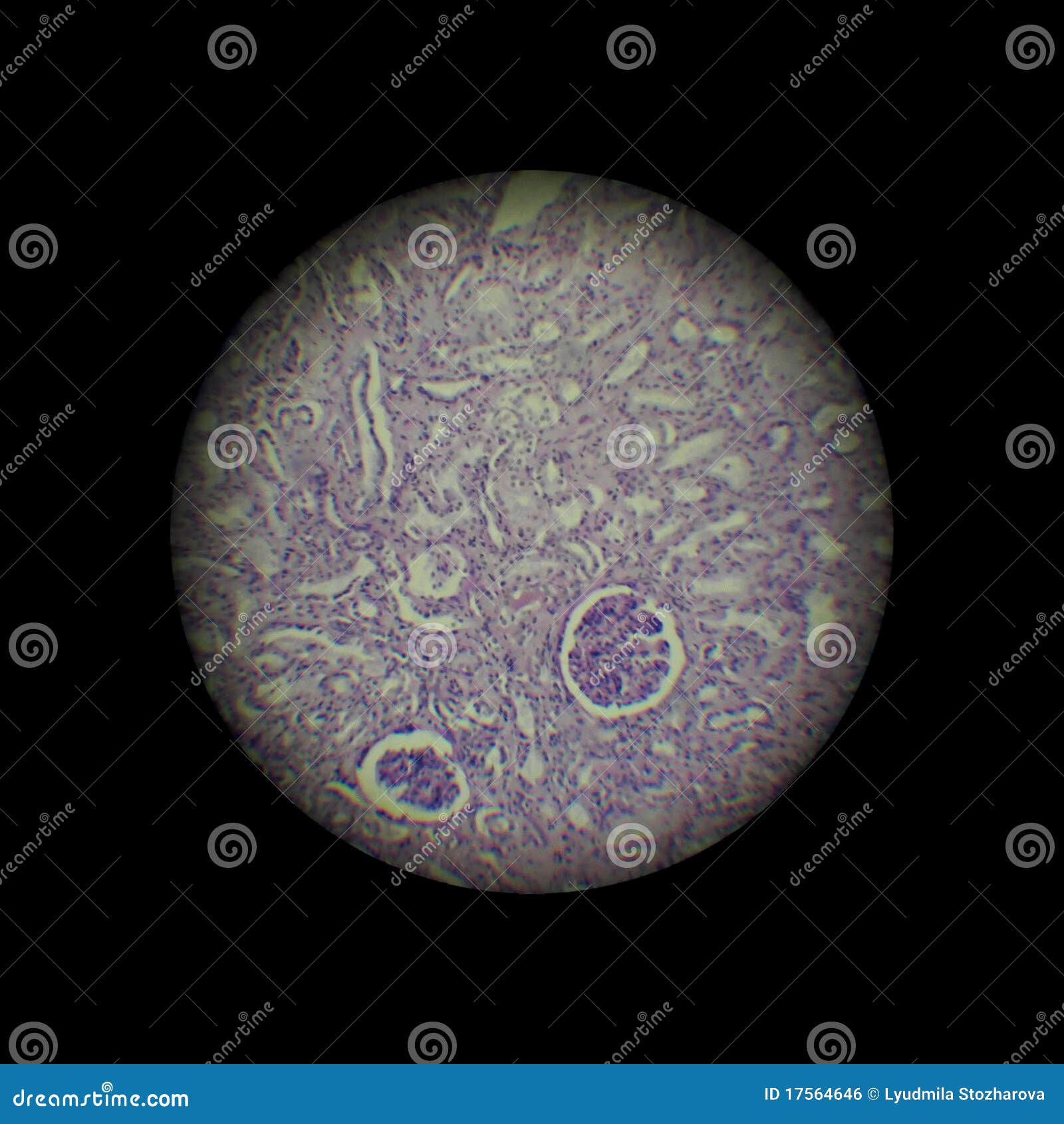 Nefrite di lupus fotografia stock. Immagine di organismo - 17564646