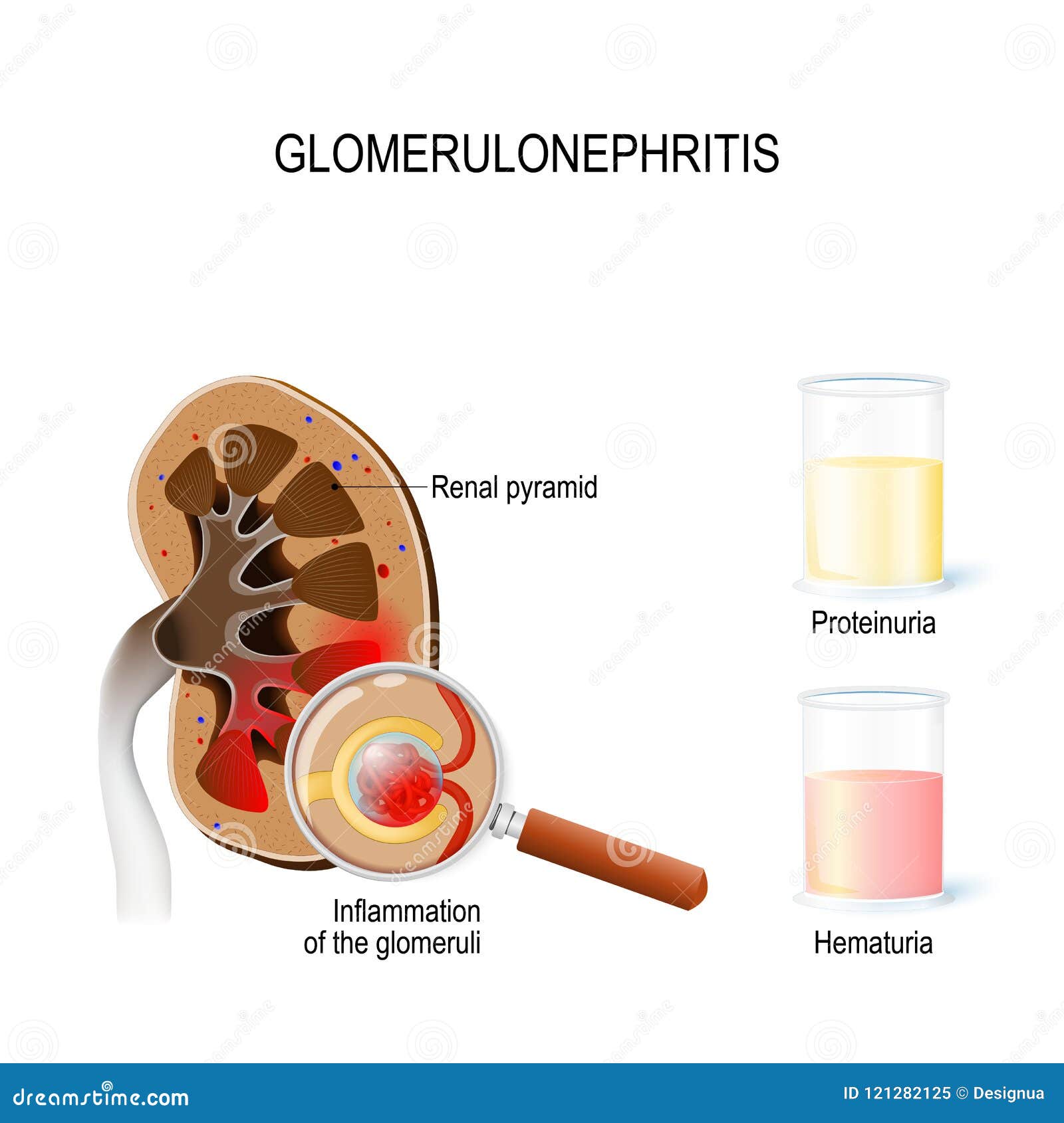 Nefrite Glomerulare Di Glomerulonefrite Rene Umano E Clo Illustrazione ...