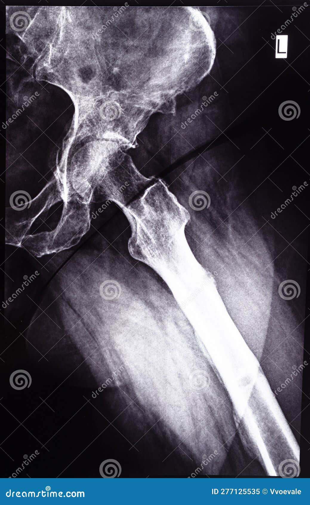 Negative X-ray Side View of Acetabular Cavity Stock Image - Image of ...