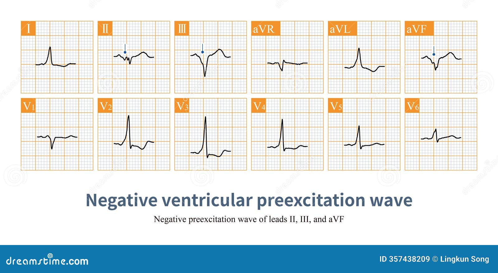 Negative Ventricular Preexcitation Wave Royalty-Free Stock Photography ...