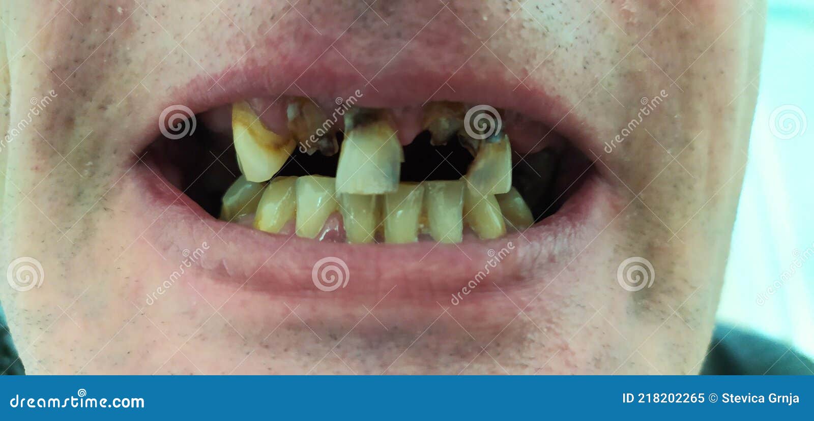 Negligence Towards Teeth, Decayed and Broken Teeth Stock Image - Image ...
