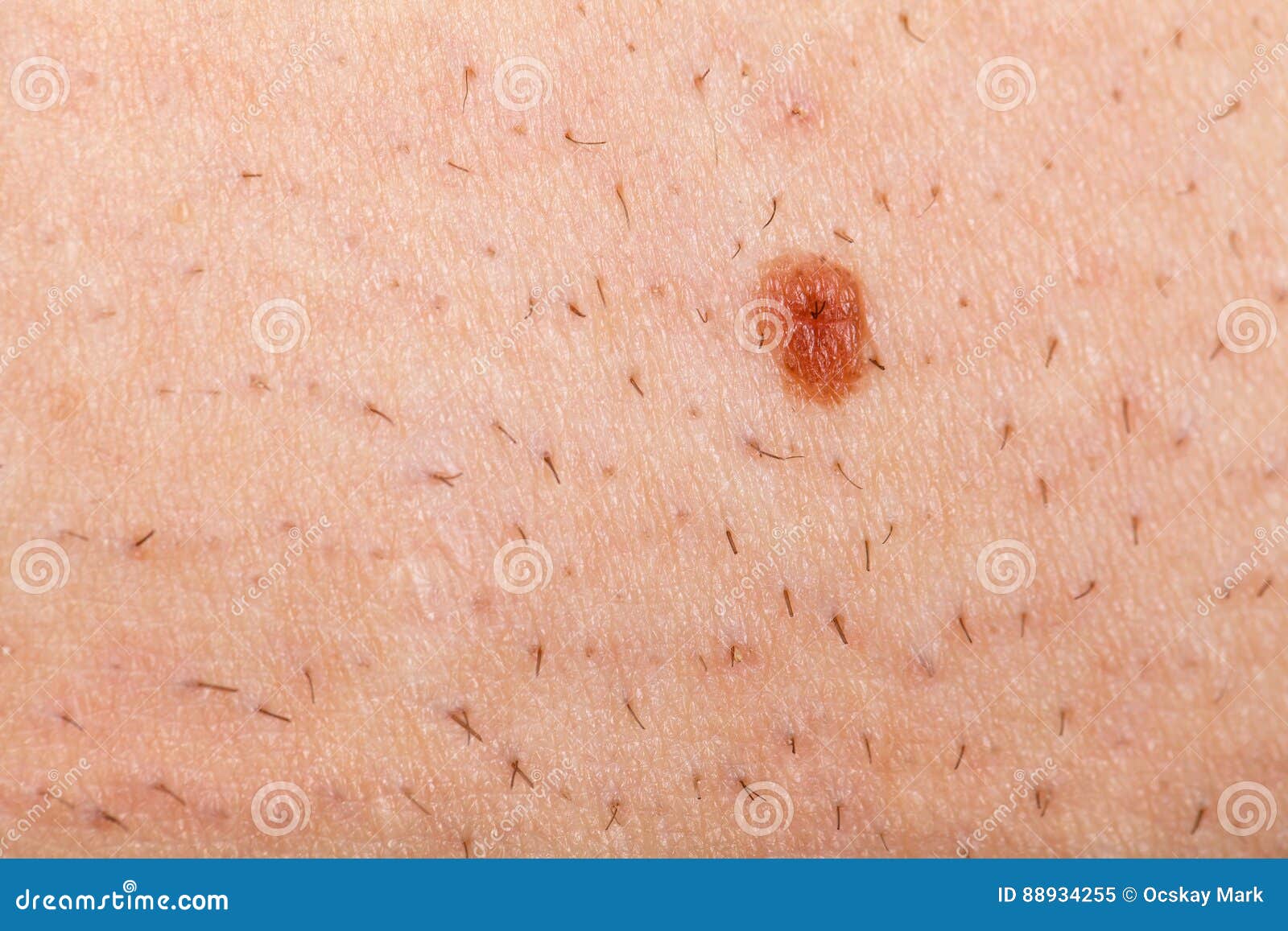 Neo Su Una Pelle Umana Rasa Immagine Stock - Immagine di biopsia ...